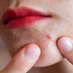 Mibazon Pentru Acnee (Pe Față) - Funcționează? • Suplimentis